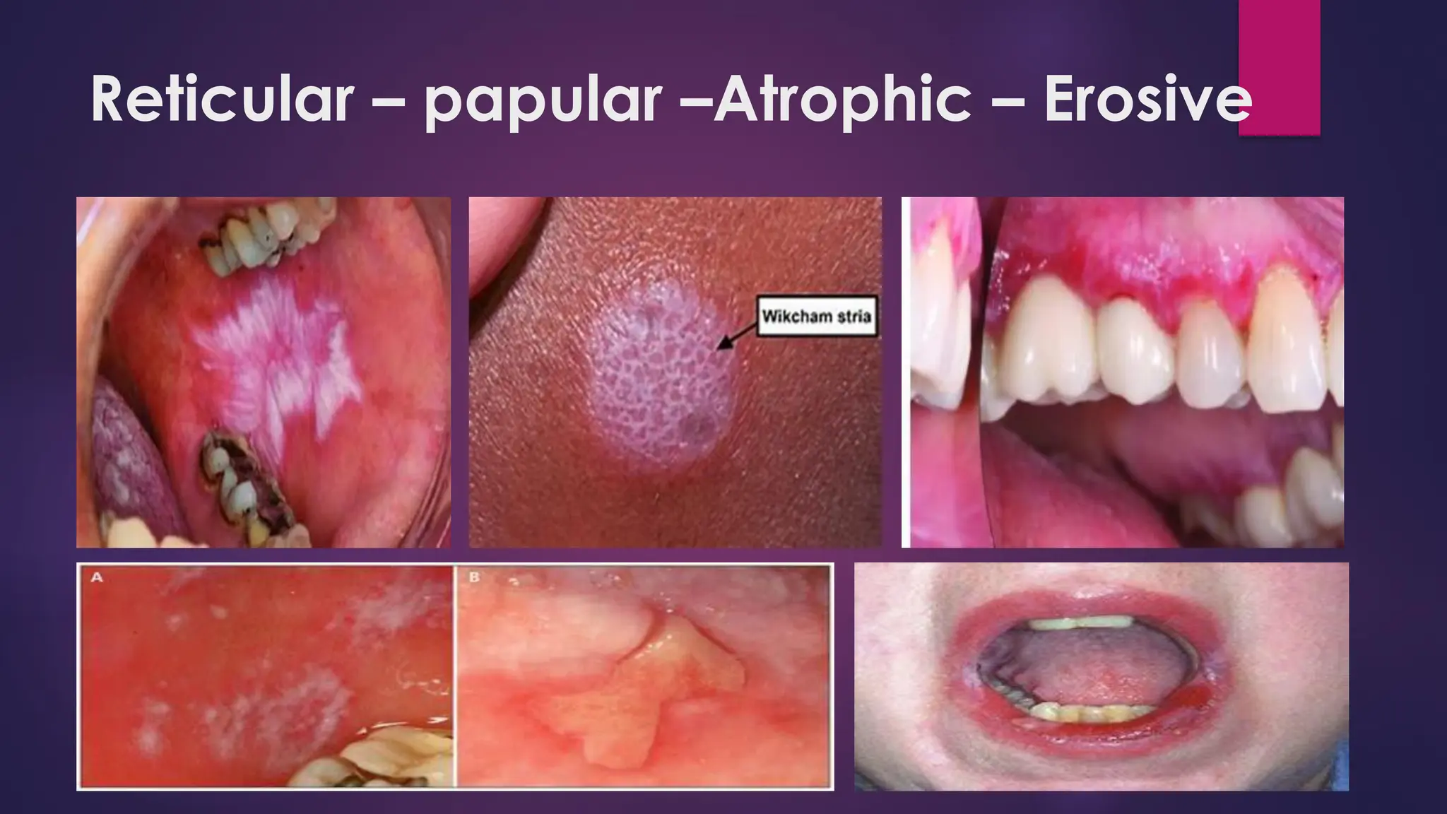The link between oxidative stress and oral lichen planus and its future implication on treatment.pdf