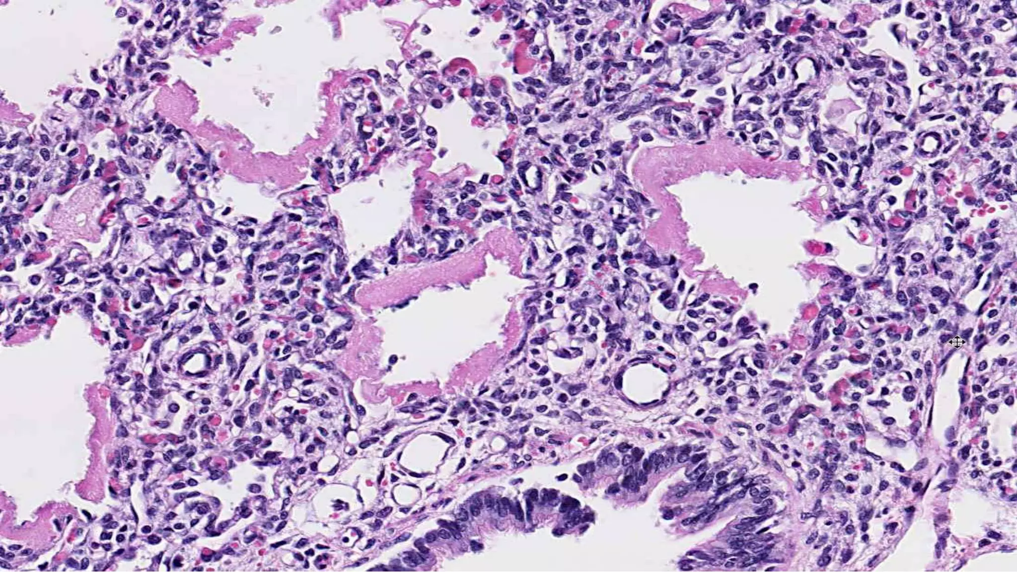 Respiratory Distress Syndrome (HYALINE MEMBRANE DISEASE) | PPTX