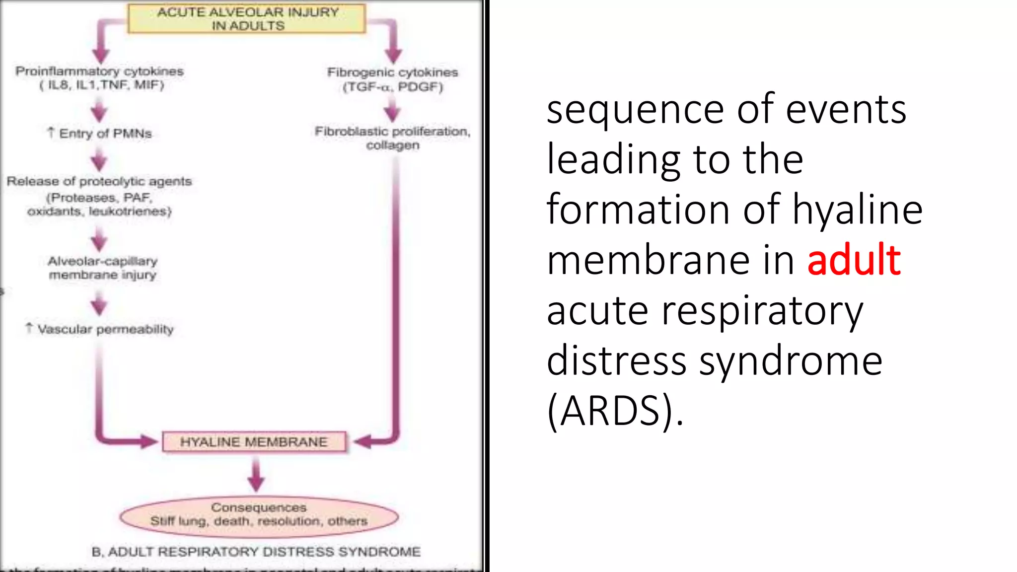 Respiratory Distress Syndrome (HYALINE MEMBRANE DISEASE) | PPTX