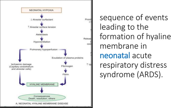 Respiratory Distress Syndrome (HYALINE MEMBRANE DISEASE) | PPTX