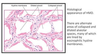 Respiratory Distress Syndrome (HYALINE MEMBRANE DISEASE) | PPT