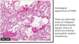 Respiratory Distress Syndrome Histology