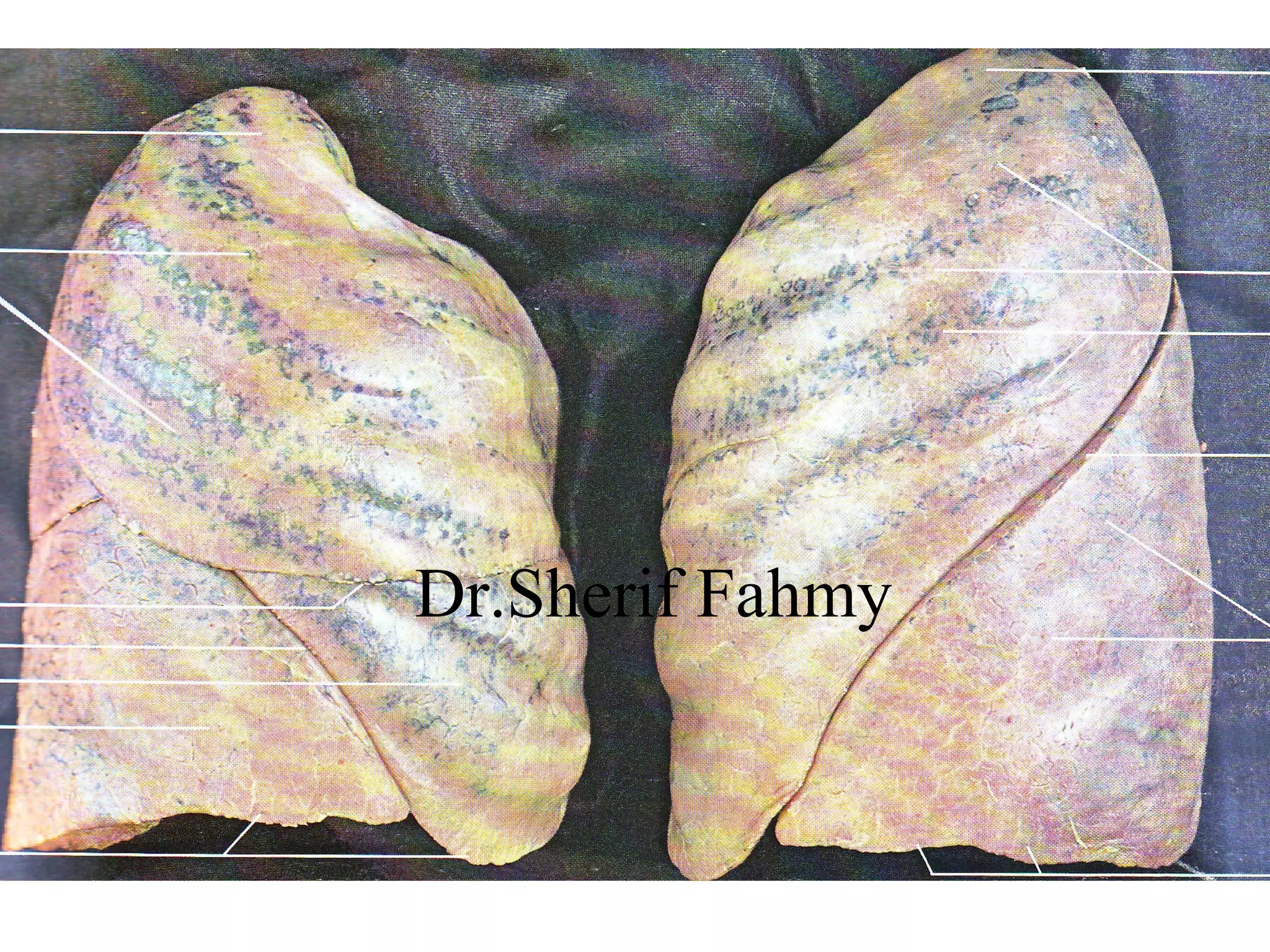 The Lungs (Anatomy of the Thorax) | PPS