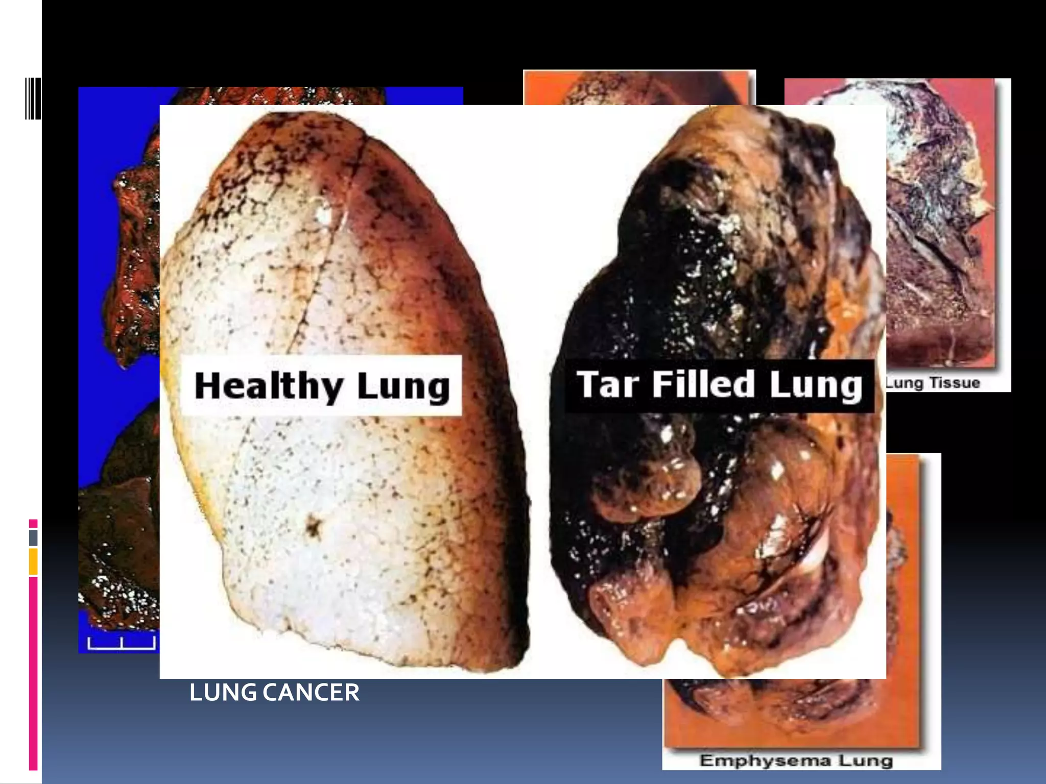 The lungs presentation | PPTX