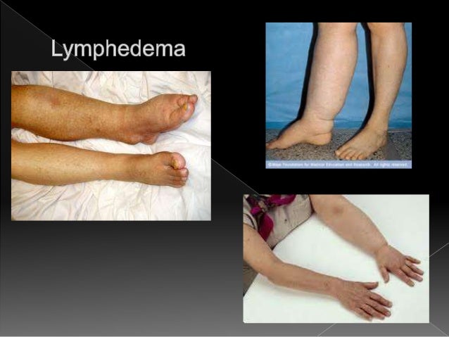 Swollen lymph nodes in groin female - ubsaad