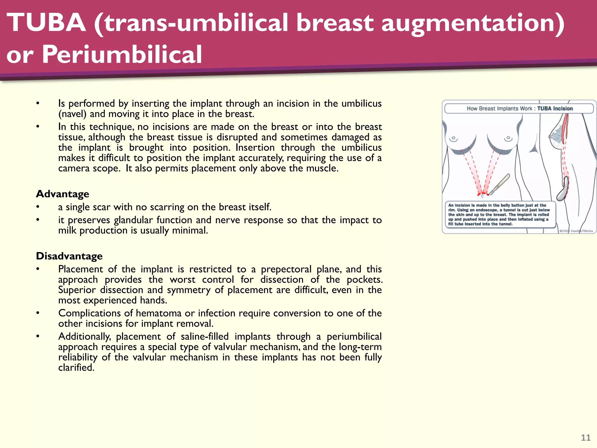 The main breast_augmentation_techniques_in_2017 | PDF