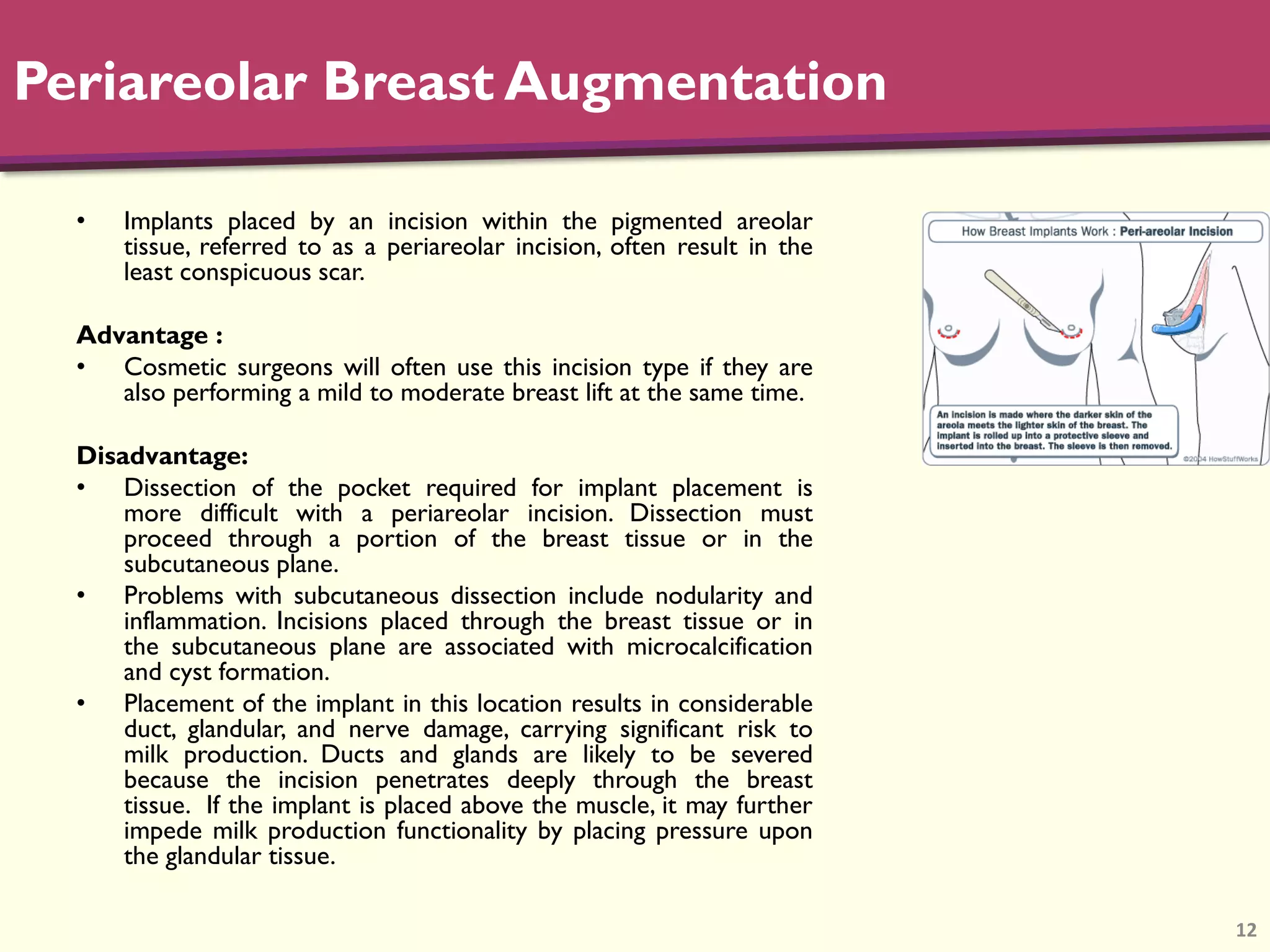 The Main Breast Augmentation Techniques In 2017 Ppt