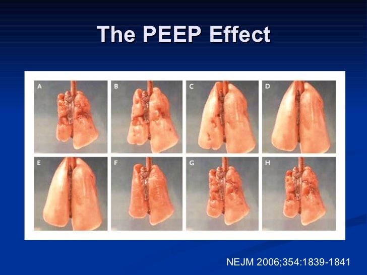 The management of acute respiratory distress syndrome