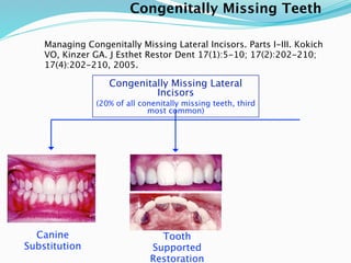 The management of congenitally missing lateral incisors h rosenberg | KEY