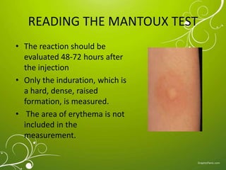 The mantoux test | PPTX