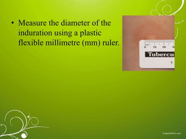 The mantoux test | PPT