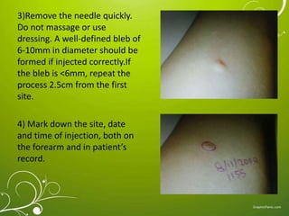 The mantoux test | PPTX