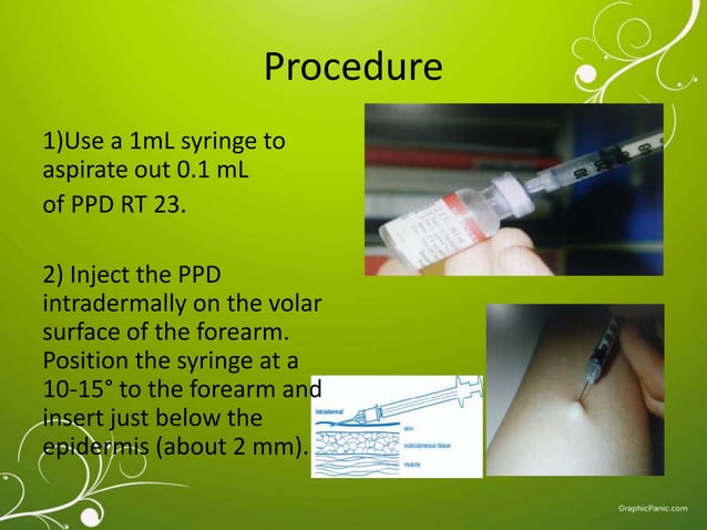 The Mantoux Test the-mantoux-test