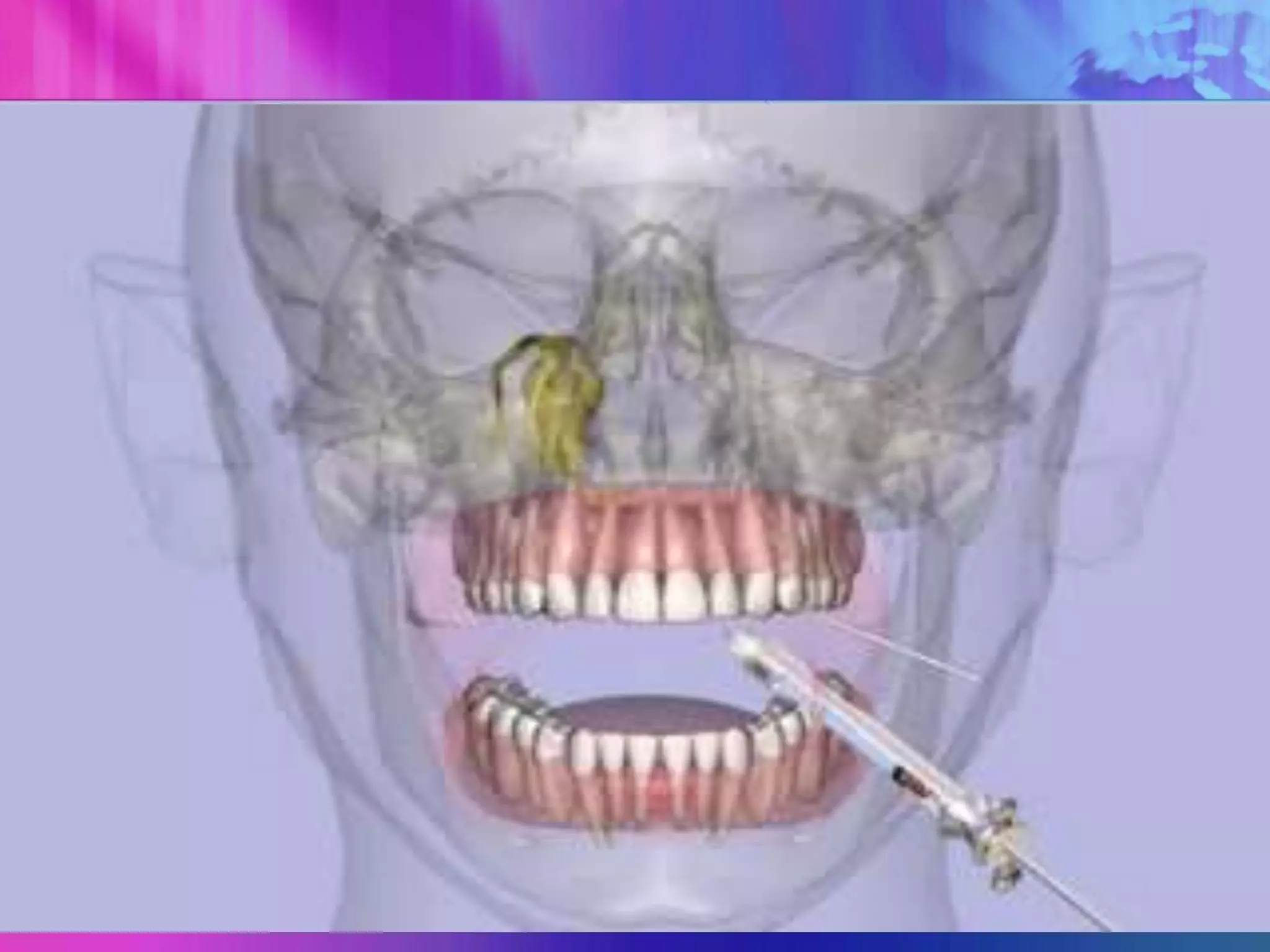 The maxillary nerve | PPTX