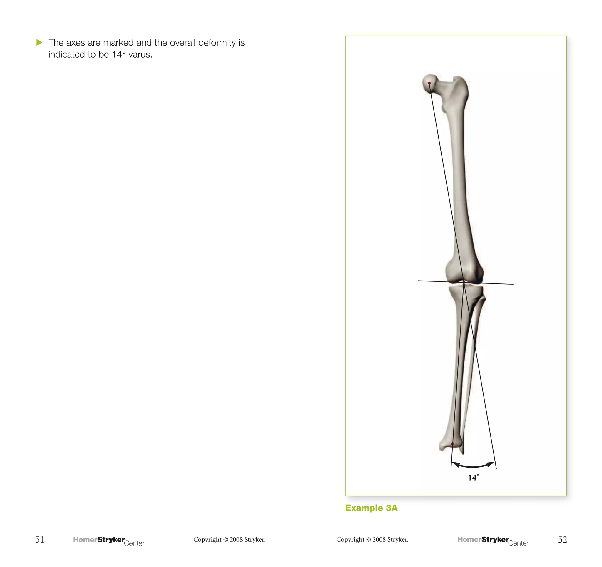 The Measurement and Analysis of Axial Deformity at The Knee.pdf