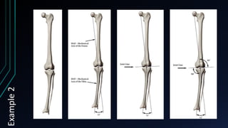 The Measurement and Analysis of Axial Deformity at The Knee.pptx