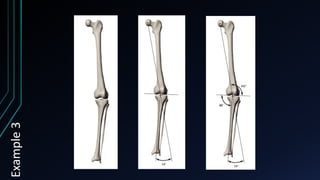 The Measurement and Analysis of Axial Deformity at The Knee.pptx