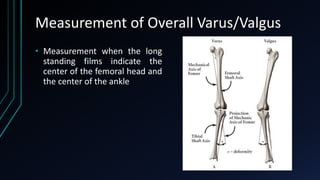 The Measurement and Analysis of Axial Deformity at The Knee.pptx