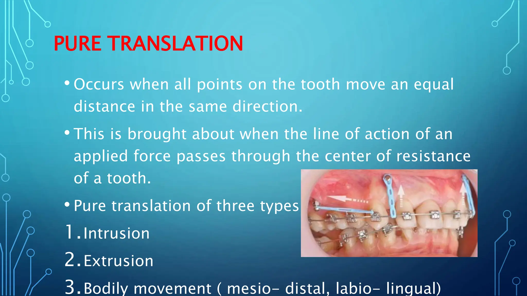 The Mechanics of tooth movement in orthodontic practice | PPTX