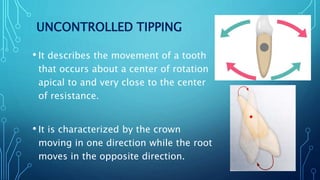 The Mechanics of tooth movement in orthodontic practice | PPTX