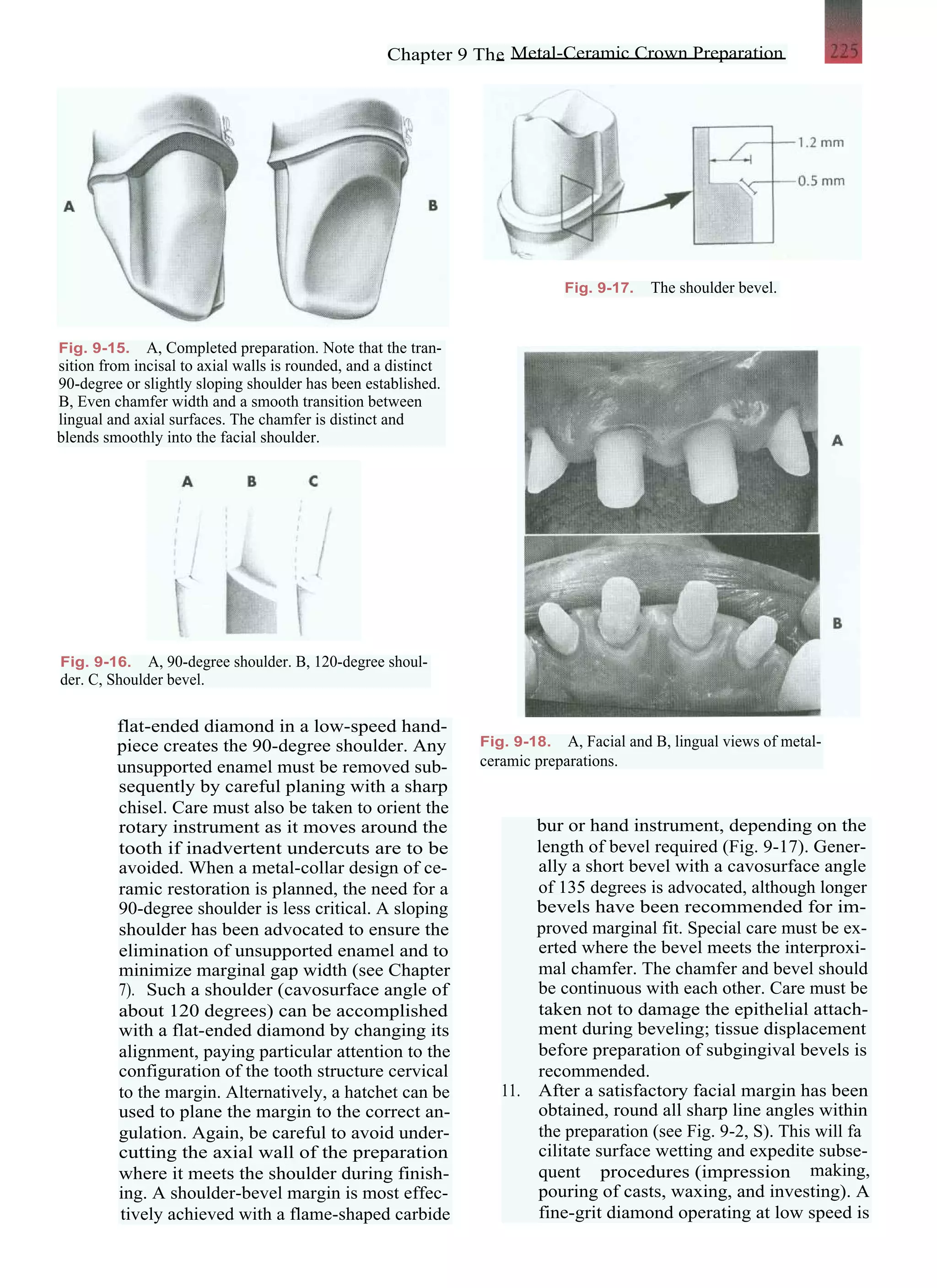 The metal ceramic crown preparation | PDF