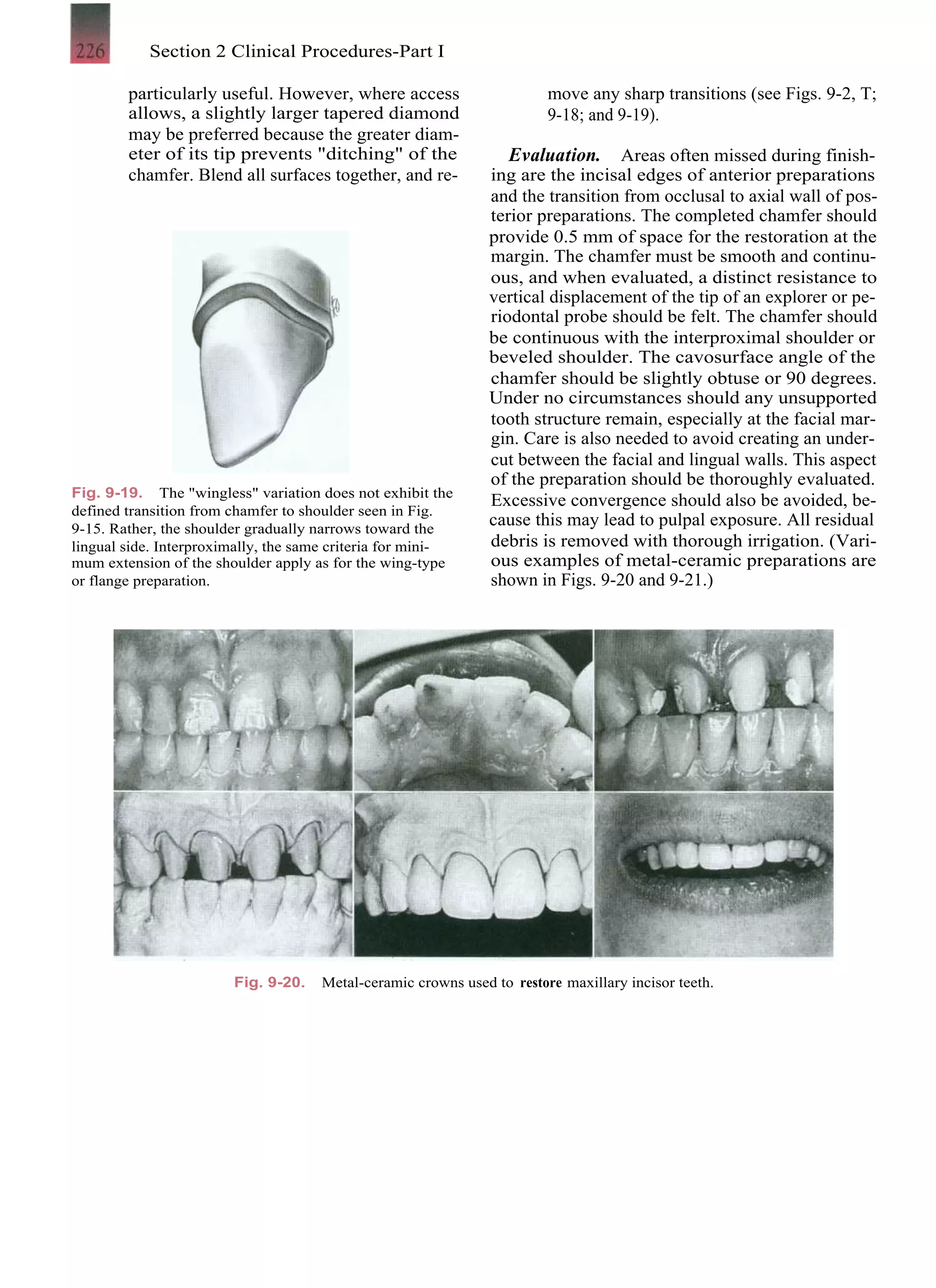 The metal ceramic crown preparation | PDF