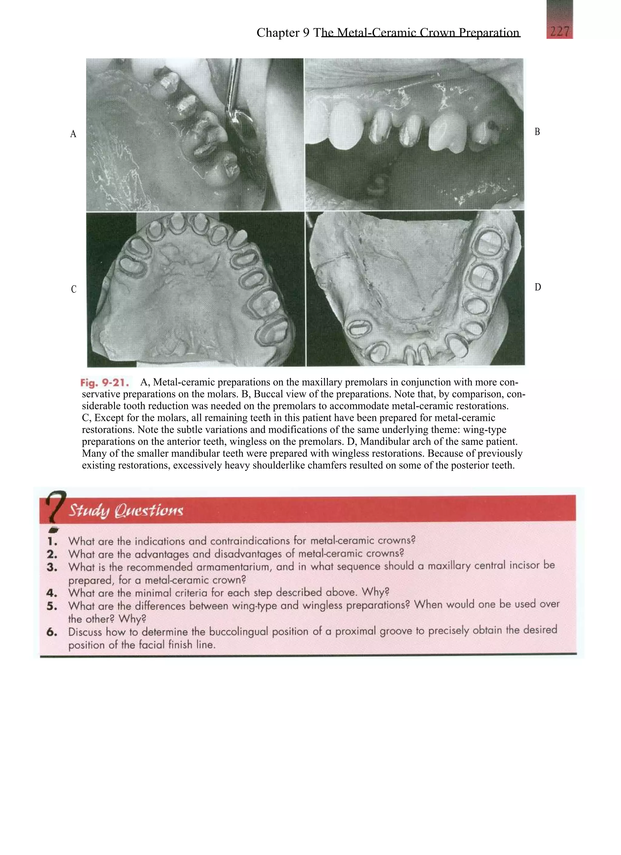 The metal ceramic crown preparation | PDF