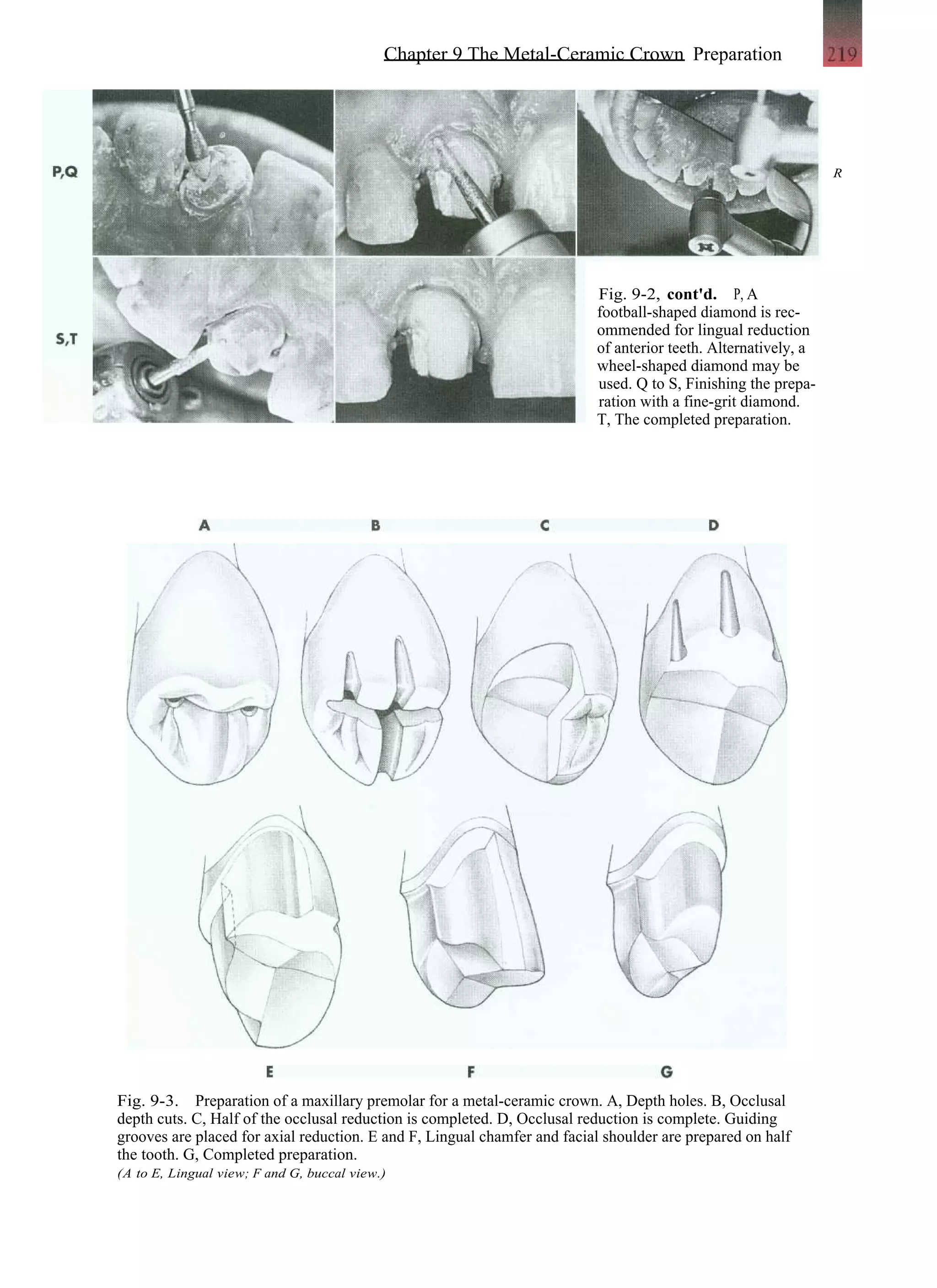 The metal ceramic crown preparation | PDF
