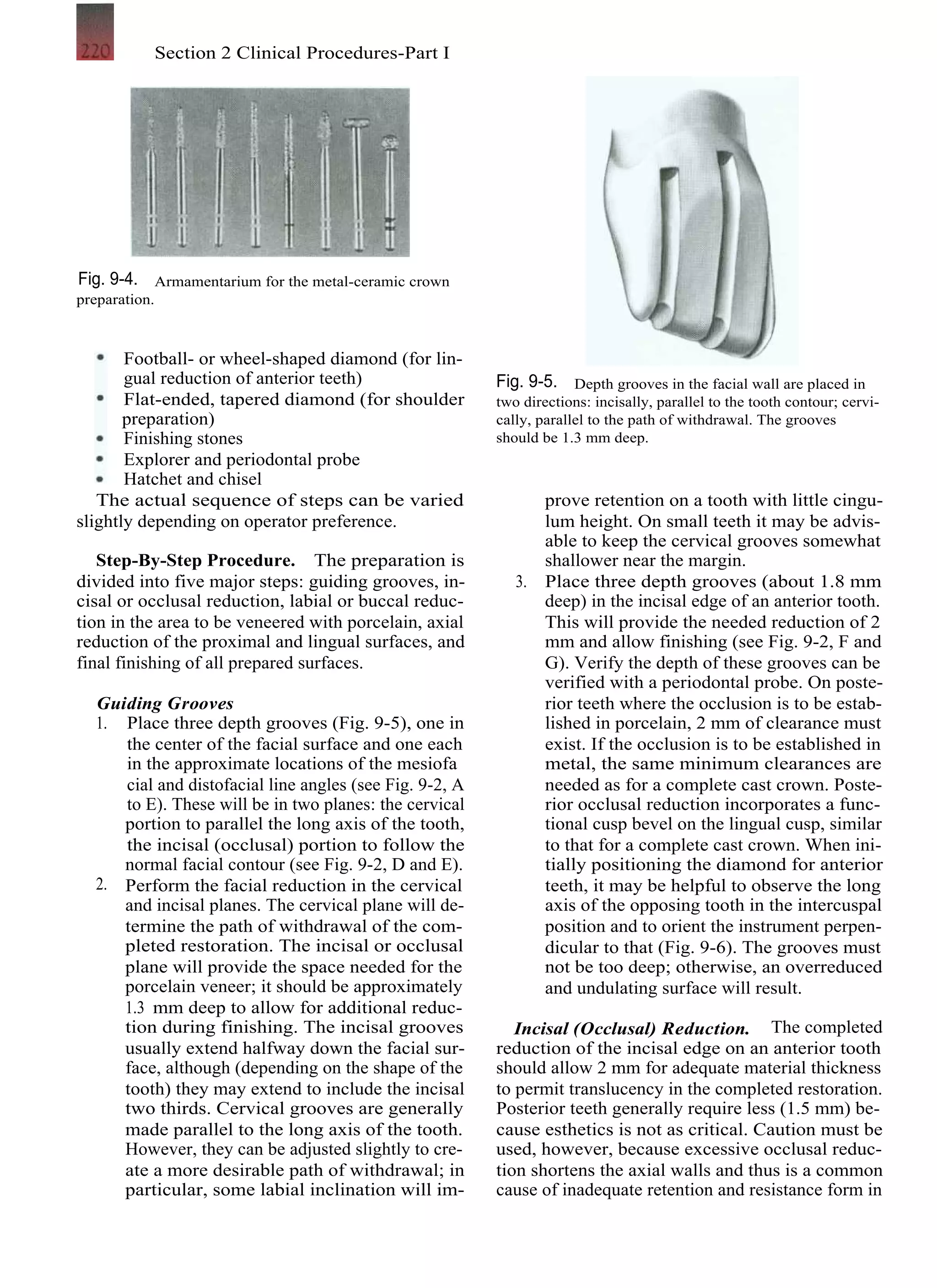 The metal ceramic crown preparation | PDF