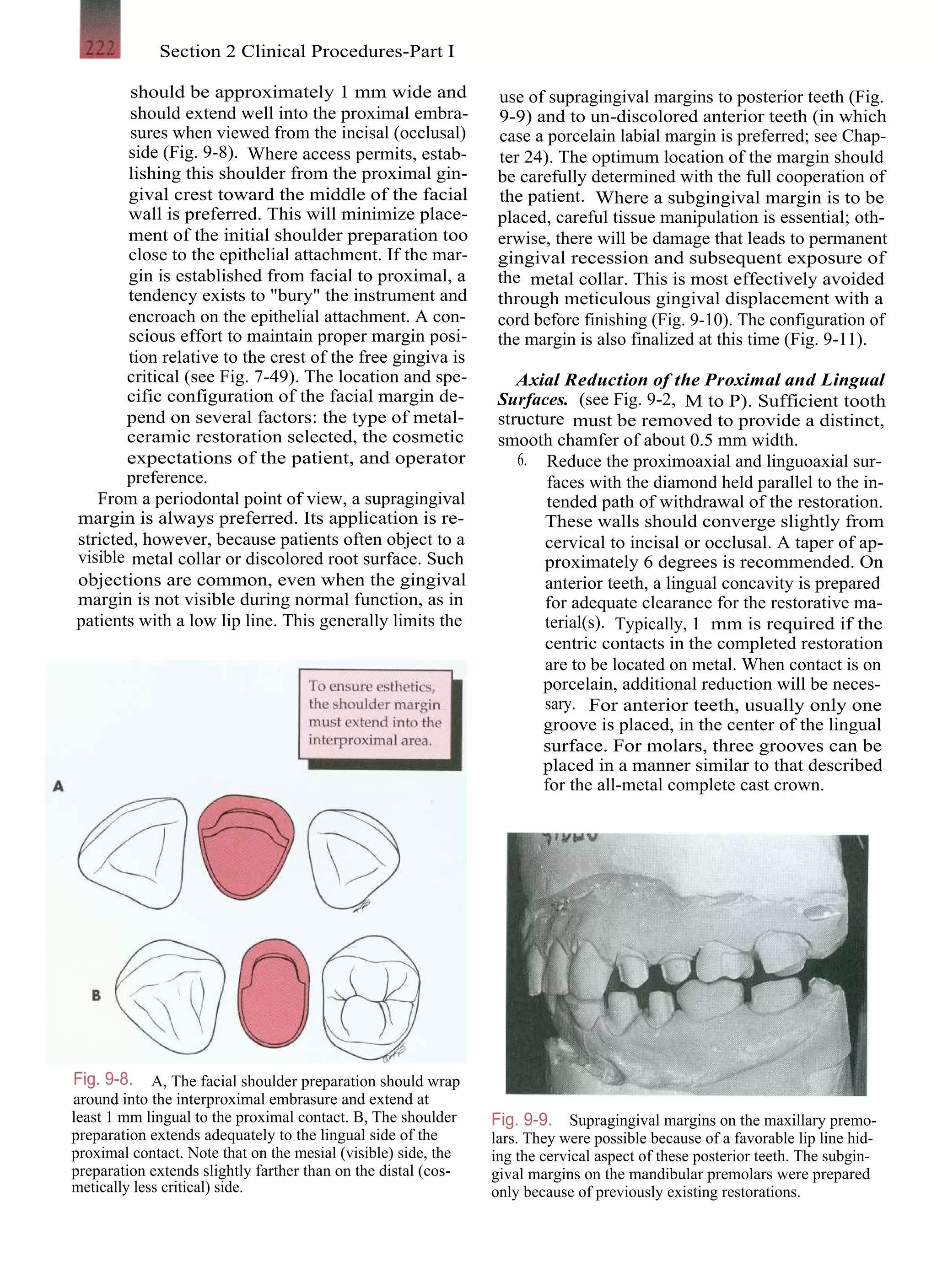 The metal ceramic crown preparation | PDF