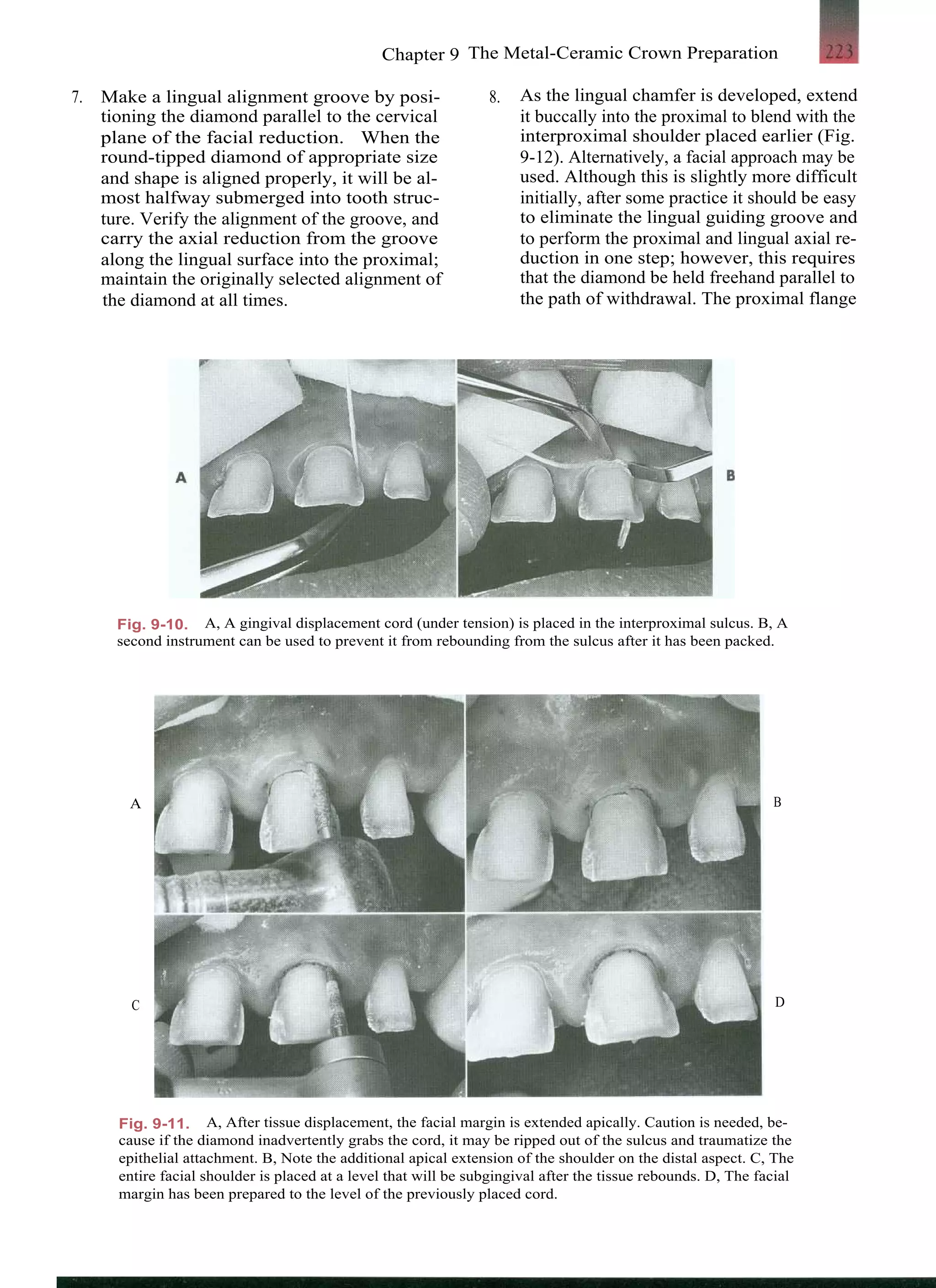 The metal ceramic crown preparation | PDF