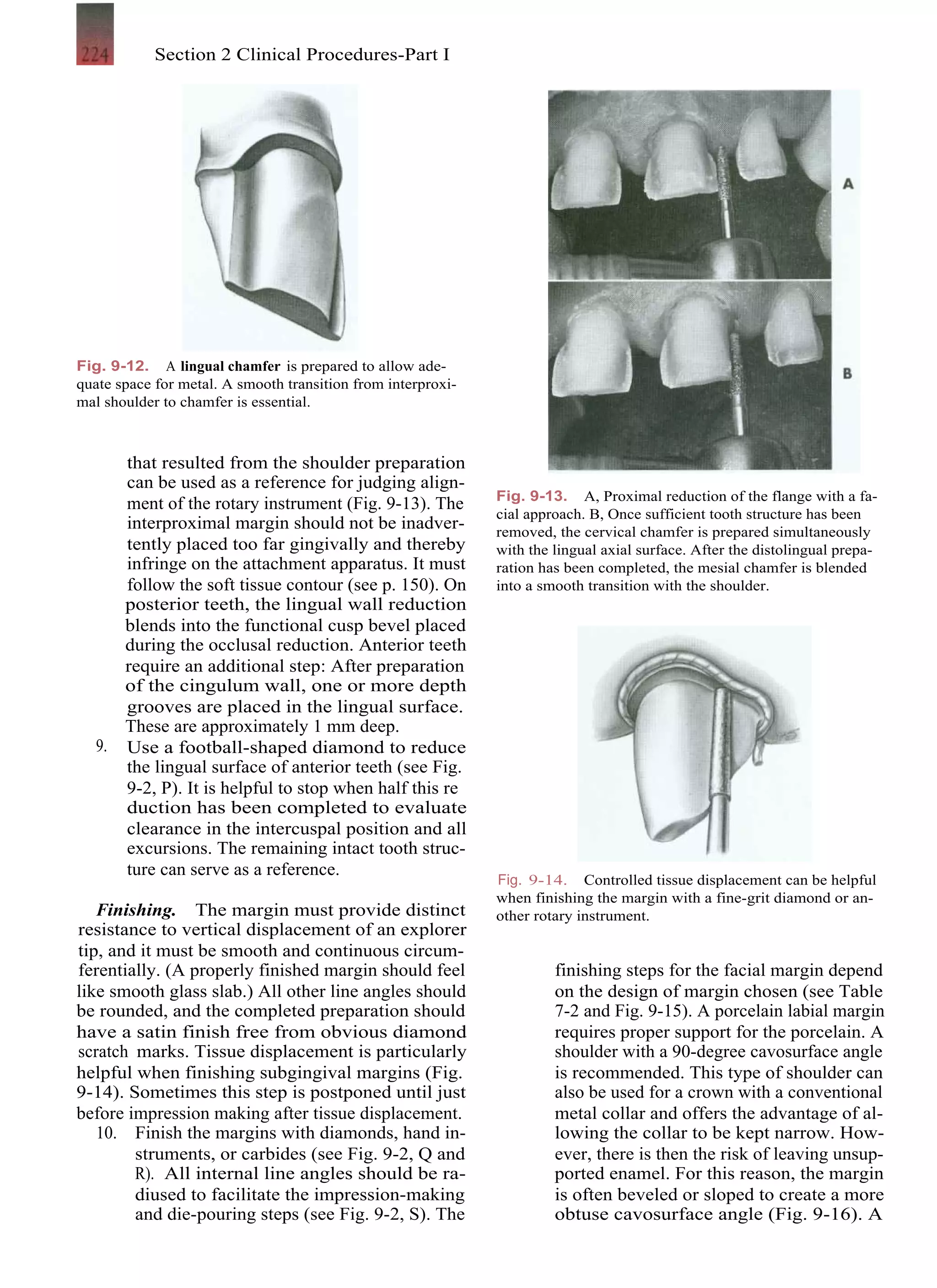 The metal ceramic crown preparation | PDF