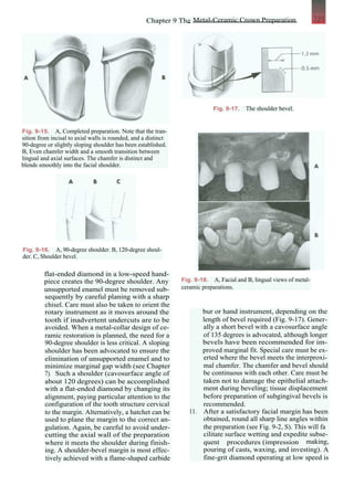 The metal ceramic crown preparation | PDF
