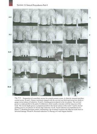 The metal ceramic crown preparation | PDF