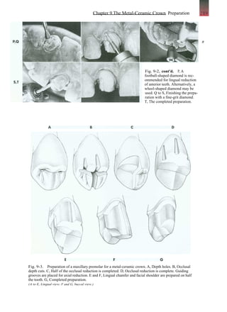 The metal ceramic crown preparation | PDF