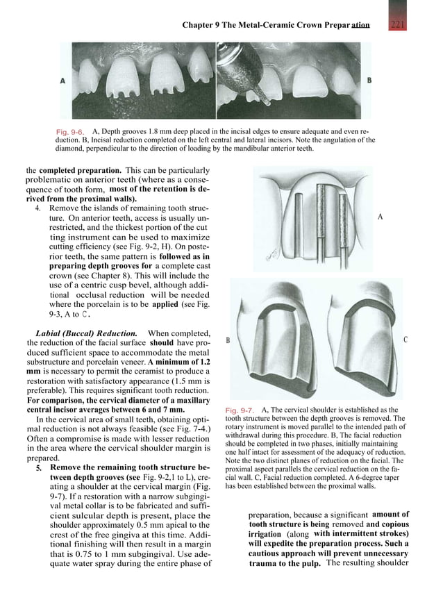 The metal ceramic crown preparation | PDF