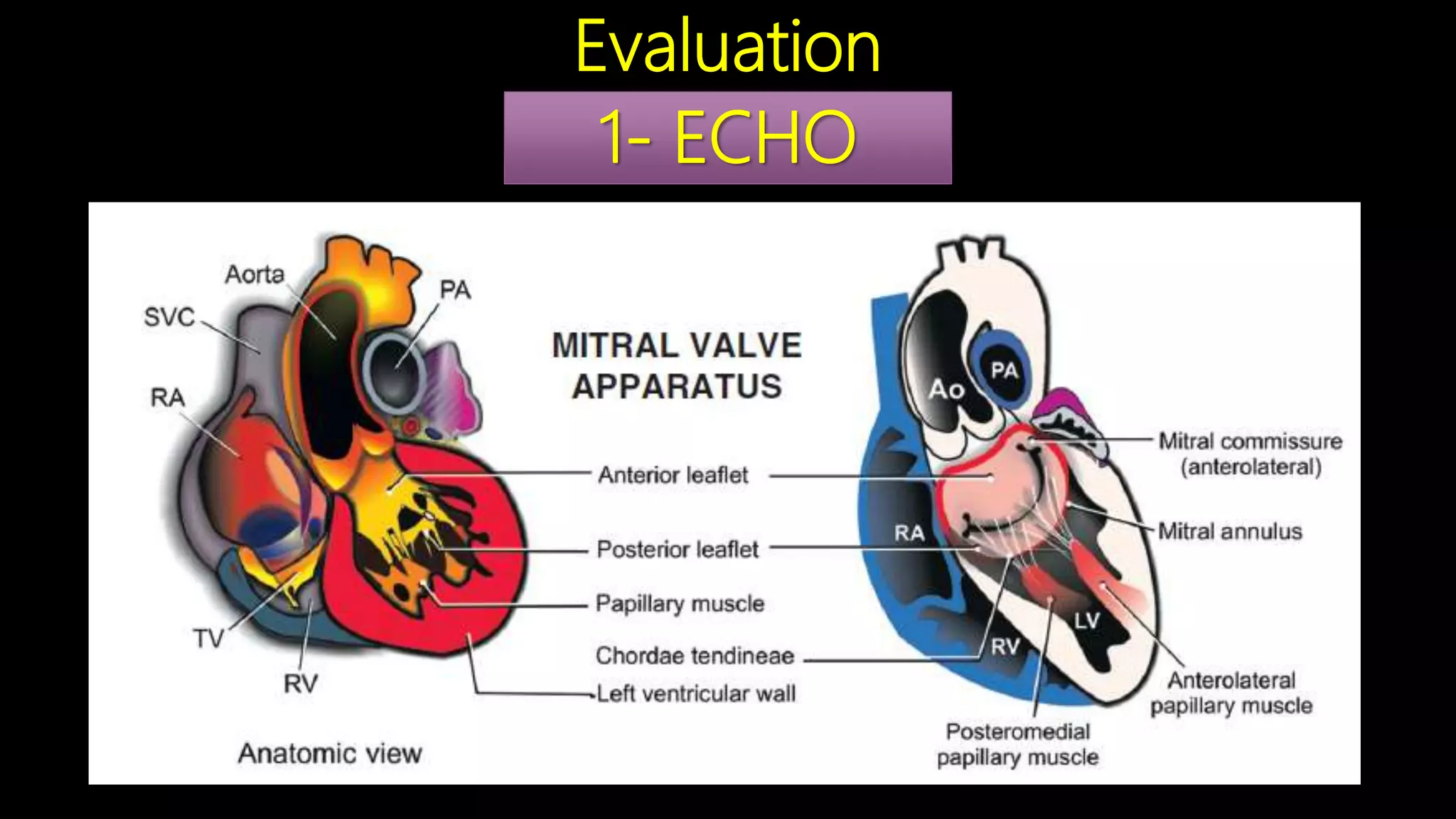 The mitral valve | PPTX | Heart and Cardiovascular Diseases | Diseases ...