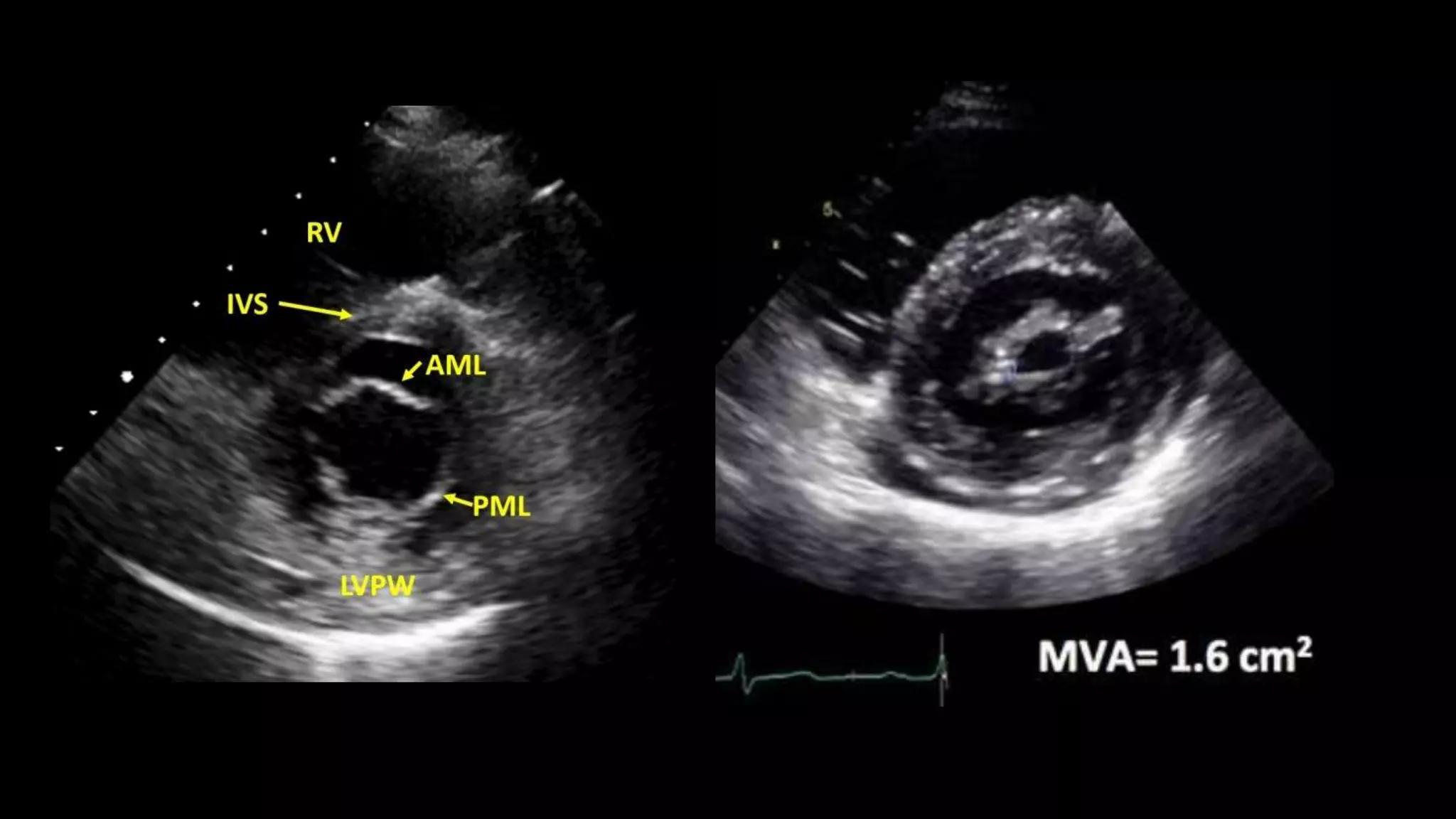 The mitral valve | PPTX | Heart and Cardiovascular Diseases | Diseases ...
