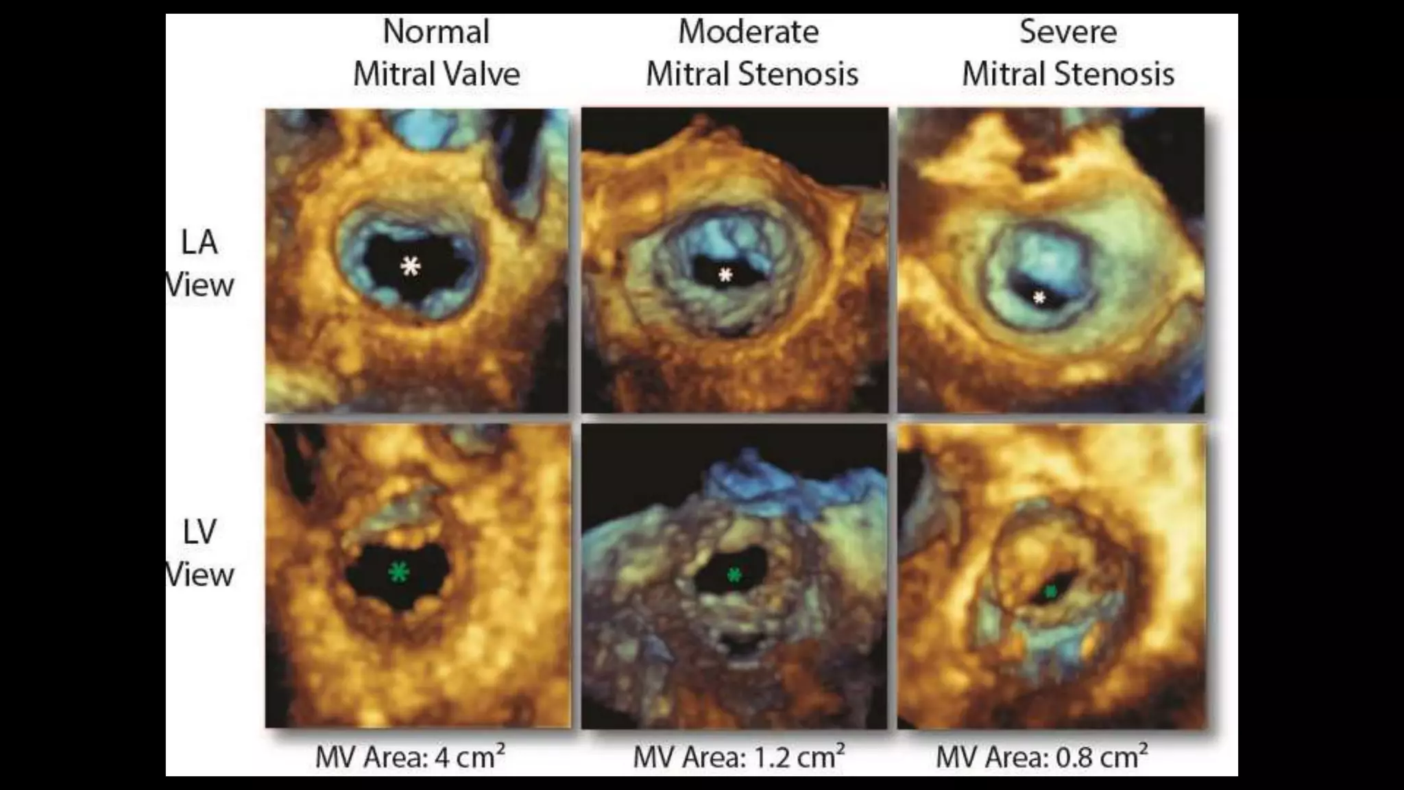 The mitral valve | PPTX | Heart and Cardiovascular Diseases | Diseases ...