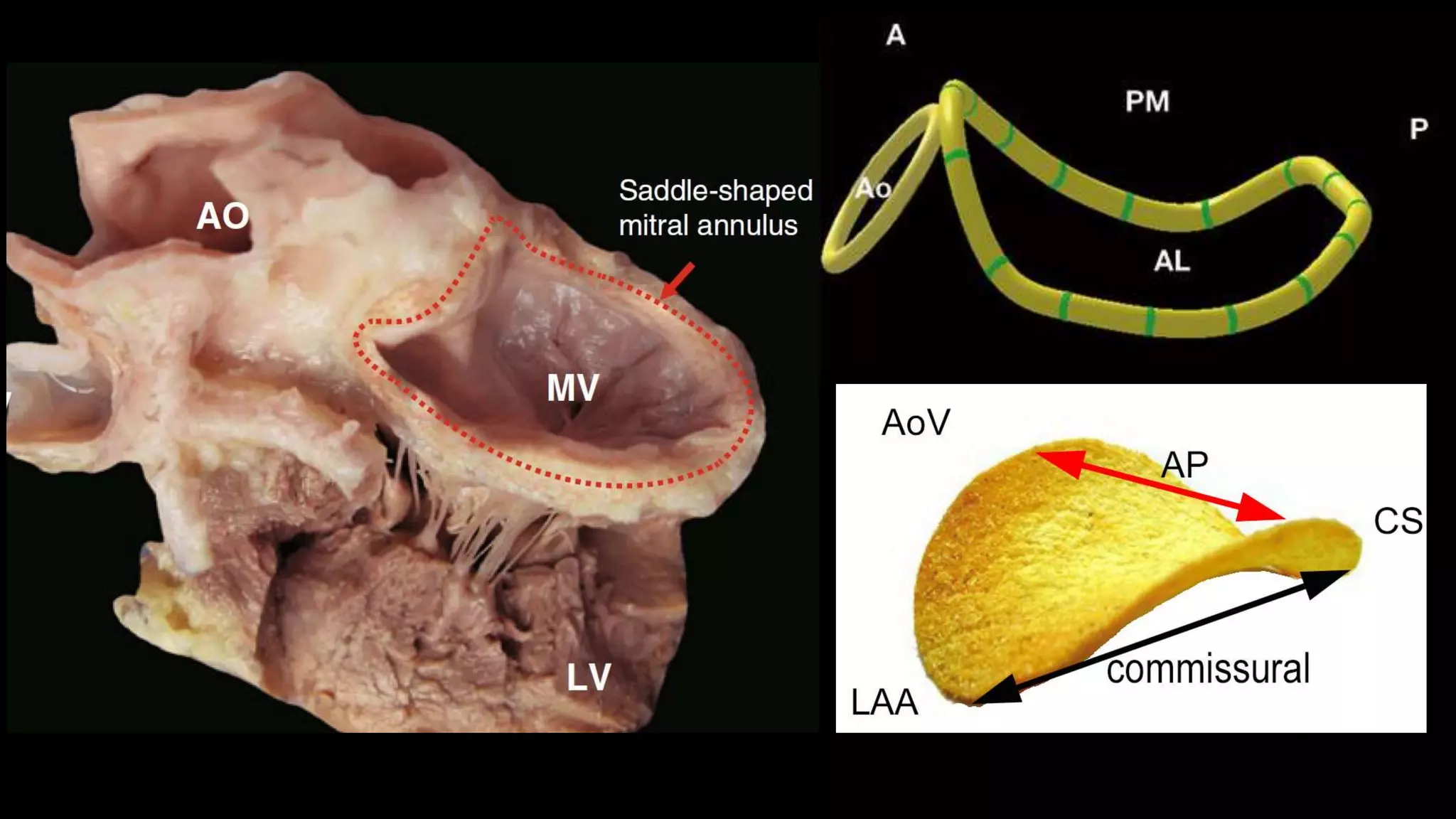 The mitral valve | PPTX | Heart and Cardiovascular Diseases | Diseases ...
