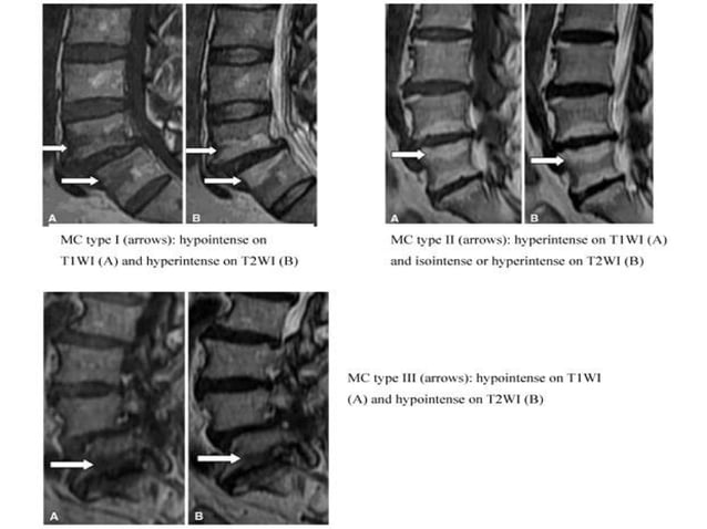 The modic vertebral endplate and marrow changes (spine 2010) | PPT