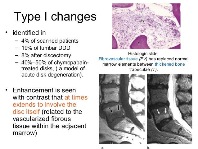 The modic vertebral endplate and marrow changes (spine 2010)
