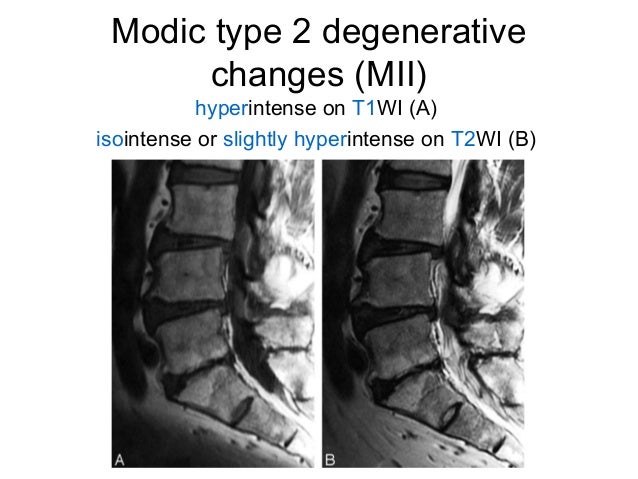 The modic vertebral endplate and marrow changes (spine 2010)