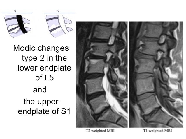 The modic vertebral endplate and marrow changes (spine 2010)