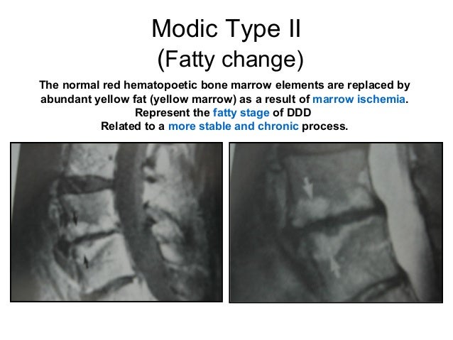 The modic vertebral endplate and marrow changes (spine 2010)