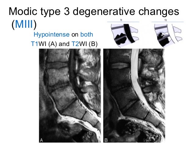 The modic vertebral endplate and marrow changes (spine 2010)