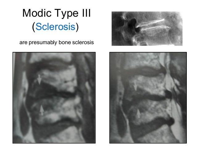 The modic vertebral endplate and marrow changes (spine 2010)