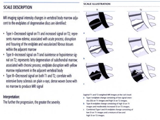 The modic vertebral endplate and marrow changes (spine 2010)