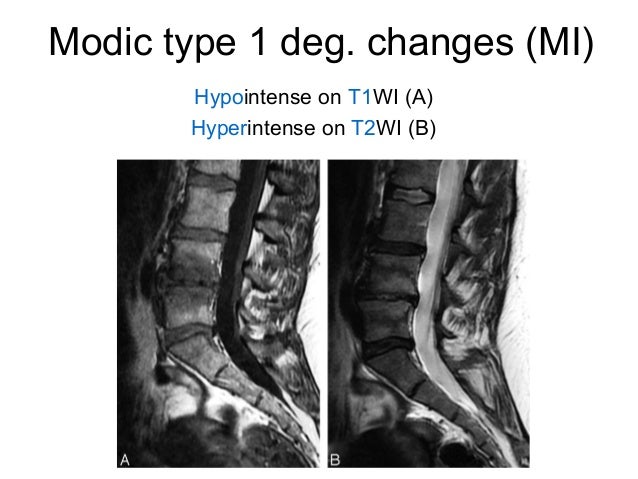 The modic vertebral endplate and marrow changes (spine 2010)