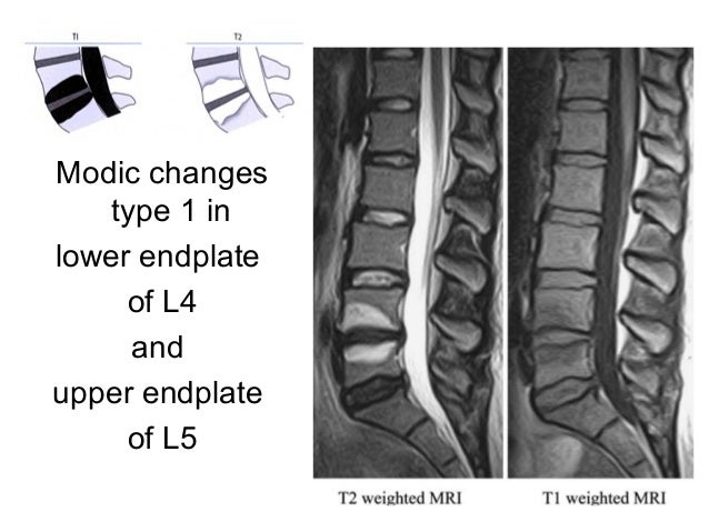 The modic vertebral endplate and marrow changes (spine 2010)